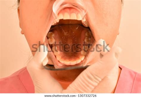13 Occlusal And Palatal Teeth Surface 免版税图片、库存照片和图像 Shutterstock