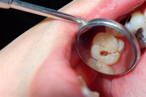 Xylitol and Cavities | Kenmore, WA | Kenmore Pediatric Dentistry