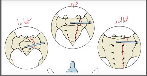 Sacral Fractures Techniques And Dysmorphism —