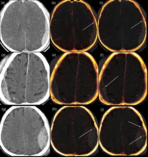 Classification Of Contrast Leakage Patterns Dual Energy Ct Images