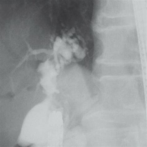 After Stone Removal Cholangiogram Showed That The Stones Were Removed Download Scientific