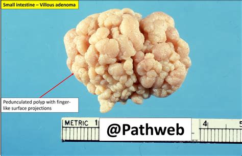Villous Polyp Gross Pictures