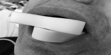 Oral Protection In Electroconvulsive Therapy Modified Techn The