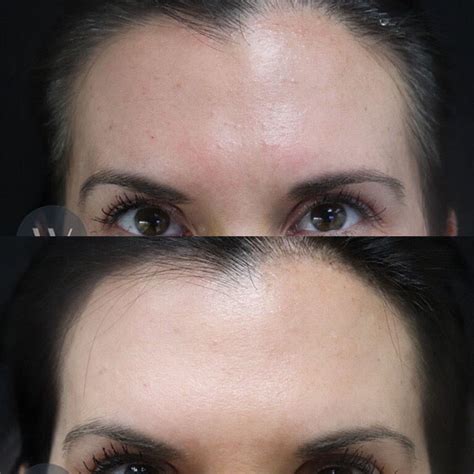 Daxxify Archives West Institute Chevy Chase Dermatology Dermatologist Bethesda Maryland