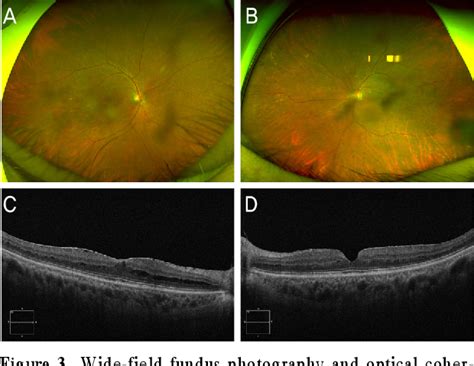 Figure 3 From Hyperviscosity Syndrome Related Retinopathy In A Patient With Waldenström