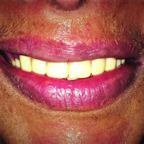 Pdf Case Report Vestibuloplasty Following Denture Hyperplasia