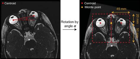 Automatic Segmentation And Quantification Of The Optic Nerve On Mri Using A 3d U Net