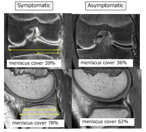 The Size Of Your Meniscus Matters An Explanation Of Knee Discomfort