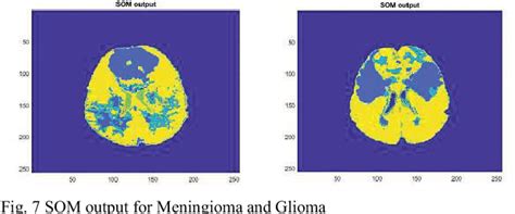 Figure 7 From Brain Tumor Type Detection Using Texture Features In Mr