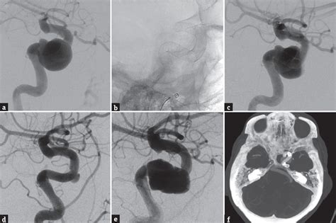 Regrowth Of A Large Intracranial Aneurysm After On Label Use Of The Pipeline Embolization Device