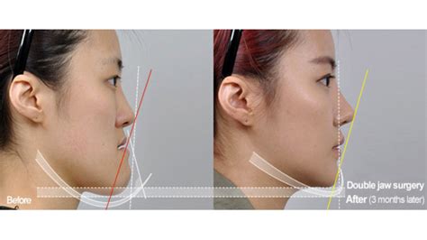 Double Jaw Surgery In Korea 2025