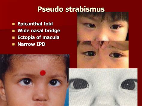 Power Point Presentation Of Clinical Evaluation Of Strabismus Pptx