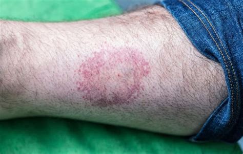 Donn Recluse Bite Bullseye