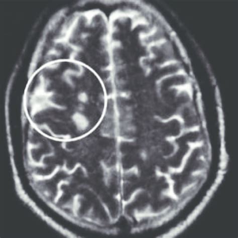 Pdf Septic Embolism A Devastating Complication Of Infective Endocarditis