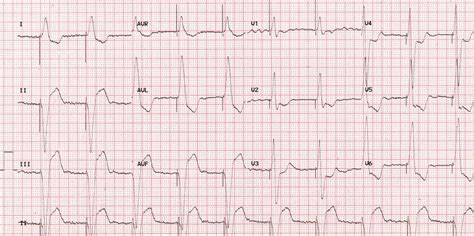 Vvi Pacing With Very Wide Qrs All About Cardiovascular System And Disorders