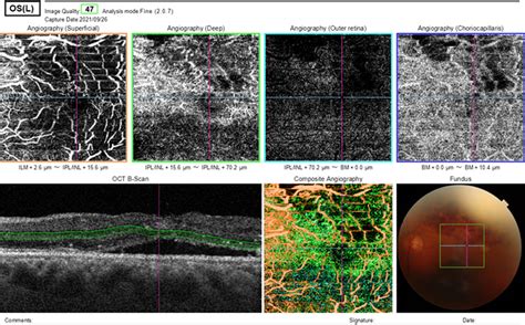 Octa Of The Left Eye Showed Decreased Vessel Density And Disrupted Download Scientific Diagram