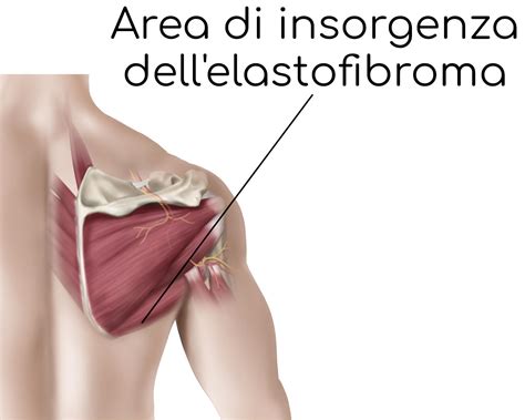 Elastofibroma Dorsi Sottoscapolare Cause Sintomi Pericoli E Cura