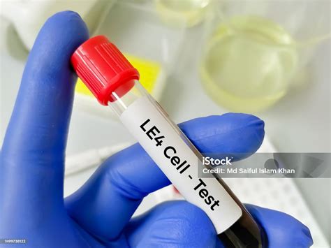 Scientist Hold Blood Test Sample Tube For Le4 Cells Test Lupus
