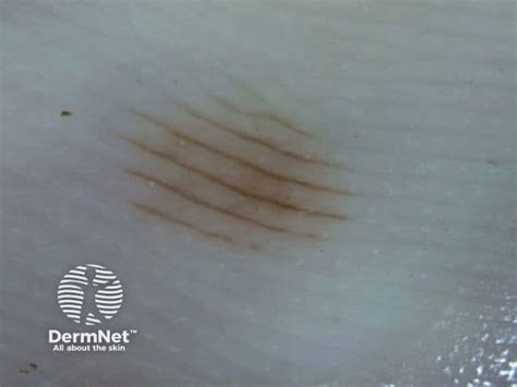 Acral Lentiginous Melanoma Dermoscopy