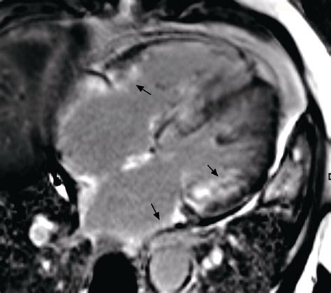 Cardiac Magnetic Resonance Imaging Showing Diffuse Subendocardial Late Download Scientific