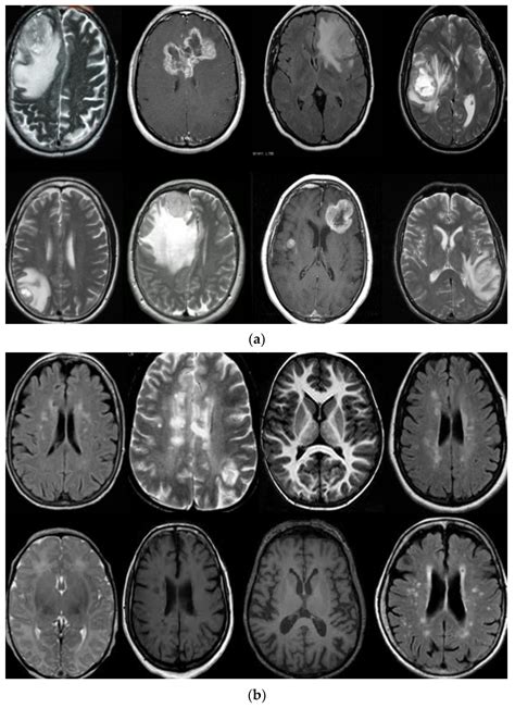 Brain Tumor Detection And Classification On Mr Images By A Deep Wavelet Auto Encoder Model