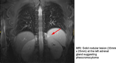 Radiologic Findings Mri Solid Nodular Lesion 33 Mm X 25 Mm At The Download Scientific