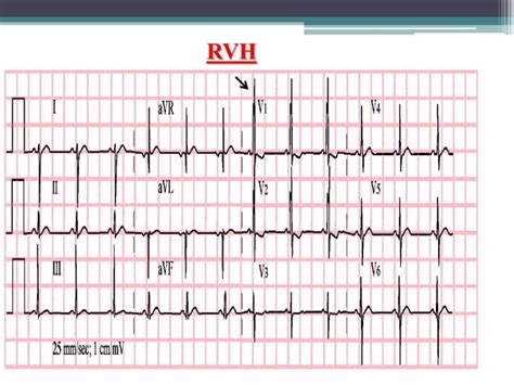 Pediatric Ecg Finalpptx
