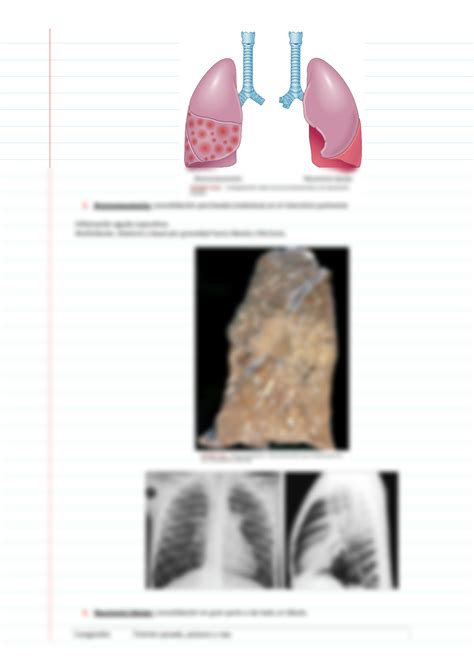 SOLUTION: Fisiopatolog a de las infecciones pulmonares - Studypool