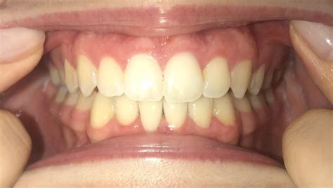 The Area Pointed Which Is Below The Extraction Is A Bit White Is It Normal R Braces