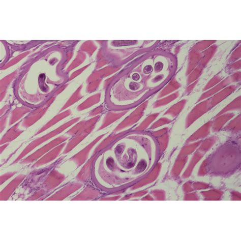 Trichinella Spiralis Encapsulated Larvae Muscle Sec Medical And