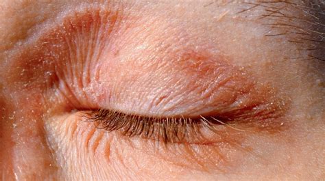 Rash 22 Common Skin Rashes Pictures Causes Treatment Artofit