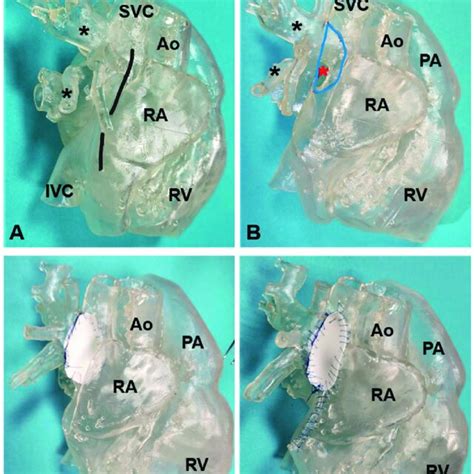 The 3d Printed Model Of A Partial Anomalous Venous Return Highlighted