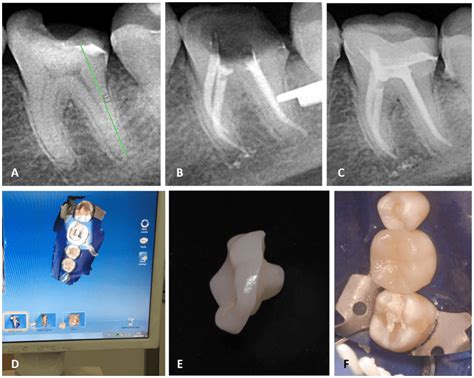 Restoration Of Root Filled Teeth Pocket Dentistry