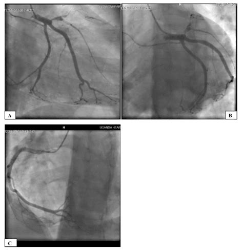 A 36 Year Old Man With Concomitant Left Ventricular Apical Thrombus And Bilateral Acute Lower