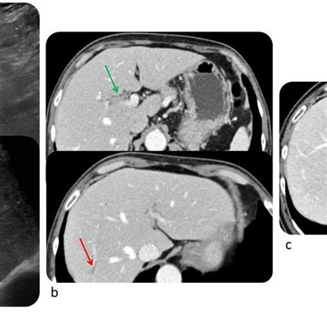 Complicated Immune Related Segmental Colitis With Diverticulosis Download Scientific Diagram