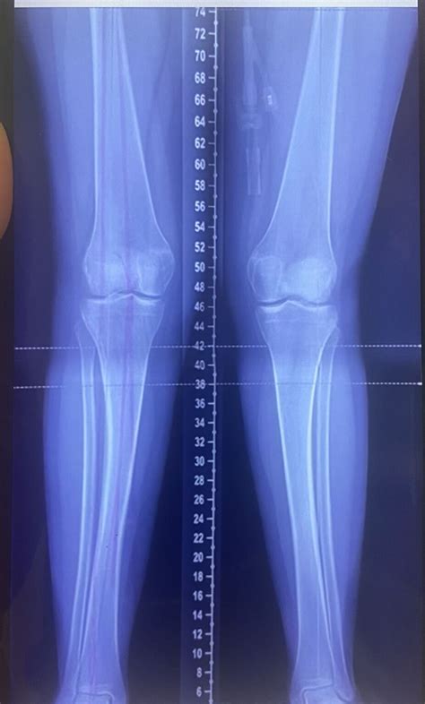 Elli Acic On Linkedin X Ray Of Bilateral Tibial Valgus Deformity In Our 17 Year Old Patient…