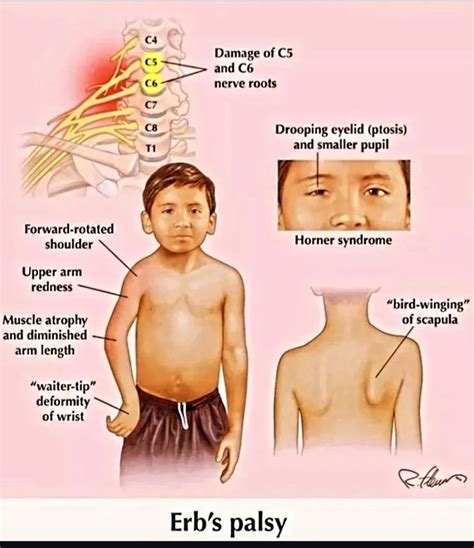 Erbs Palsy In 2025 Erb Palsy Basic Anatomy And Physiology Plexus