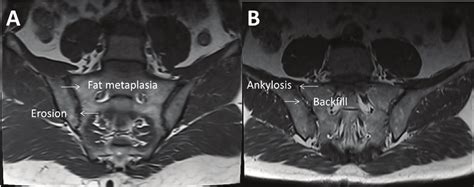 Mri Findings Of Inflammatory Lesions In The Stir Sequence Of Sij Mri Download Scientific