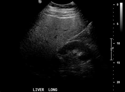 Radiopaedia Case Diffuse Hepatic Steatosis Grade III Id 80807 Study 94285 NC Commons