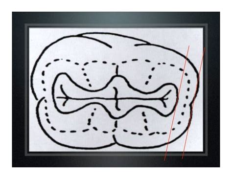 Amalgam Cavity Preparation Class I Pdf Dental Health Diseases And Conditions