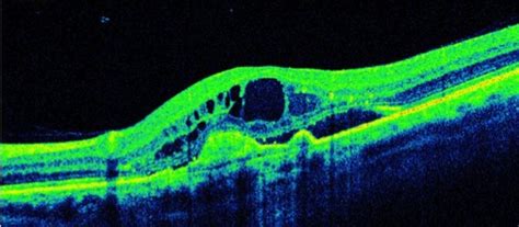 Choroidal Neovascular Membrane Oct Overview Of Oct Dataset Healthy