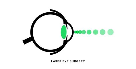 Premium Vector Lasik Eye Surgery