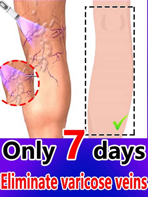 Varicose Vein Cream Vasculitis Treatment Cj Radiant