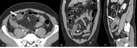 Ct Features With Histopathological Correlation In Inflammatory Versus Benign And Malignant