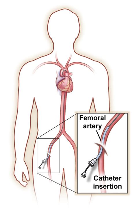 Angiograms And Angioplasty Using Your Bodys Vascular Highway To