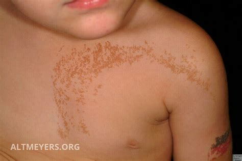 Epidermal Nevus