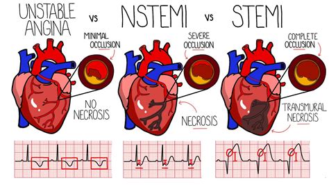 Acs Nstemi Definition At Raymond Terrell Blog