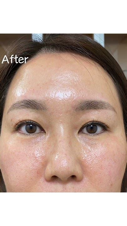 콜드플라즈마 시술후 얼마나 피부가 좋아졌을까 콜드플라즈마 플라즈마 플라즈마수강 콜드플라즈마수강 용산플라즈마 기미없애는법 잡티제거 Youtube
