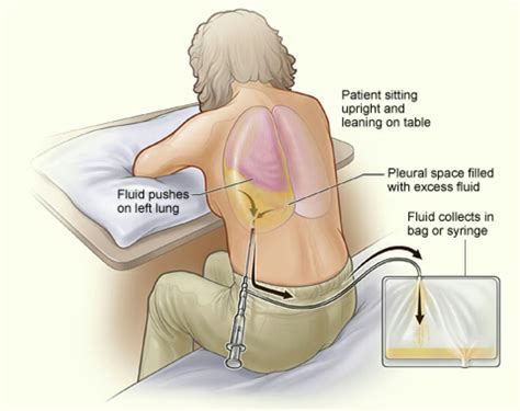 What Is Thoracentesis Procedure And Risks Artofit