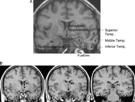 Demarcation Of Temporal Lobe Structures A Coronal Slice Showing